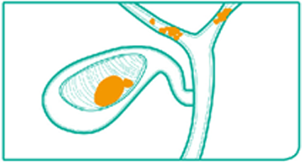 Electrohydraulic Lithotripter – Potent Medical